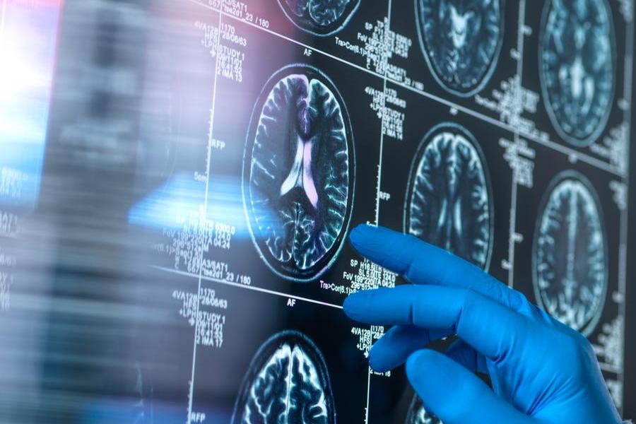 Saudi: SFDA approves rapid biotech test for early Alzheimer’s detection