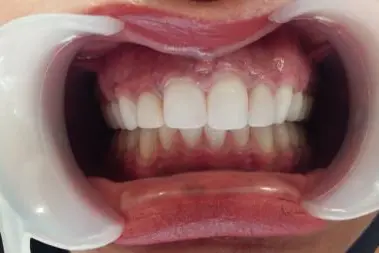 Incredible transformations of gums and teeth through latest Diode Laser